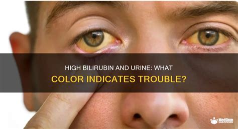 High Bilirubin And Urine What Color Indicates Trouble Medshun