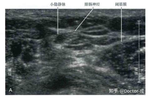 笔记 腓肠神经 知乎