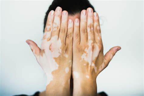 Leucoderma Vitiligo Treatment