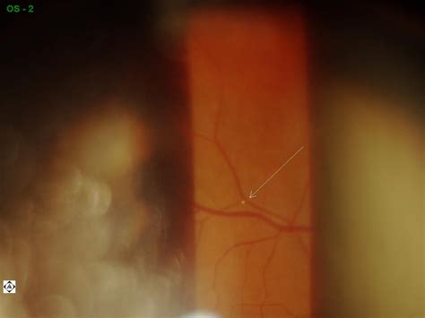 Retinal Arteriole Embolism Sonoran Desert Eye Center