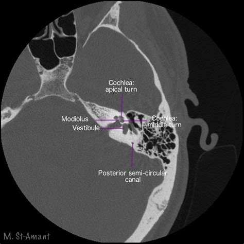 Radiopaedia Case Inner Ear Anatomy Annotated Ct Id 55637 Study