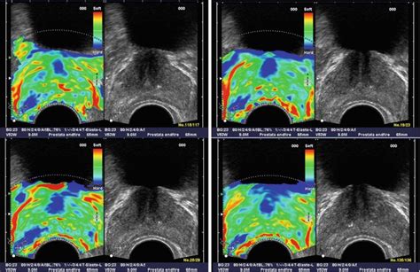 Advanced Ultrasound Prostate Elastography And Photoacoustic Imaging