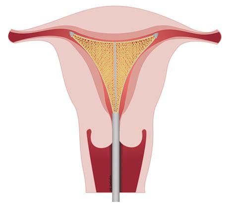 Endometrial Ablation Normal Imaging Appearance And Delayed