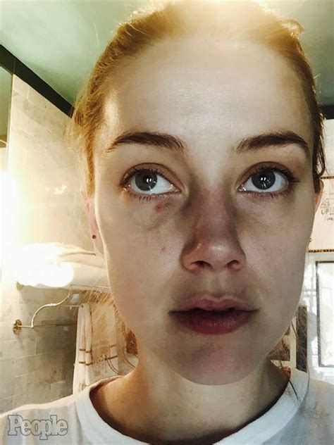 New Photos Show Amber Heard With Other Injuries Allegedly Caused By