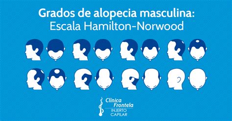 Grados De Alopecia Masculina Escala Hamilton Norwood
