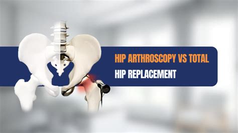 Hip Arthroscopy Vs Total Hip Replacement A Comprehensive Comparison