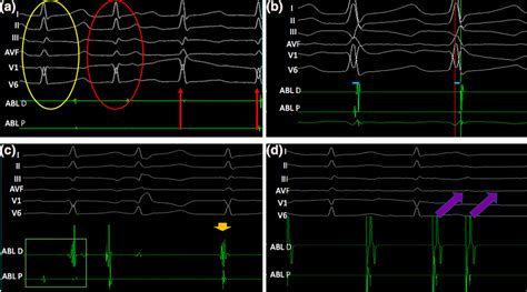 Electrogram Egm From Ablation Catheter In Atrium A Premature