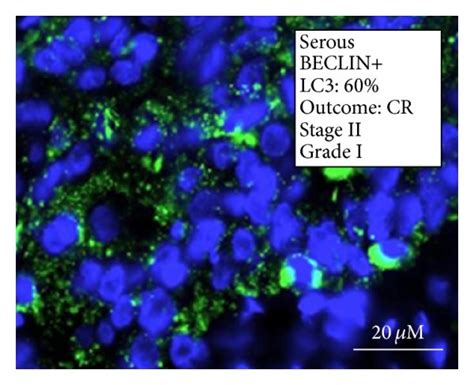 Immunofluorescence Staining Of Lc3 In Ovarian Cancer Tissue Sections