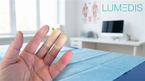Raynaud Syndrom Lumedis Ihre Handspezialisten