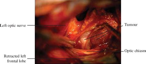 Intraoperative Image Showing A Dense Calcified Tumour Dissected Off The