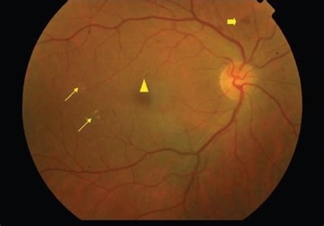 Od At Presentation With Non Proliferative Diabetic Retinopathy Thin