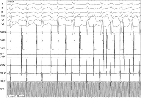 Antidromic Tachycardia With The Earliest Retrograde Activation In The