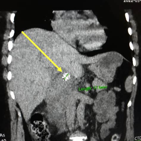 Coronal Reconstruction Of An Abdominal Ct Scan Showing Partial
