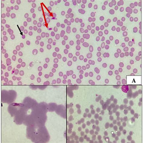 Positive Dat Of Post Transfusion Sample Using Polyspecific Ahg