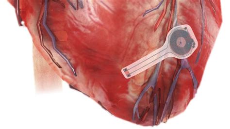 Dissolving Pacemaker Impressive In Early Research