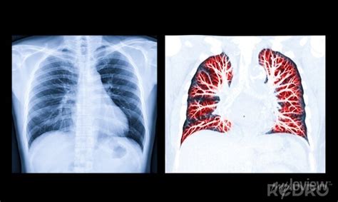 Chest X Ray Or X Ray Image Of Human Chest Or Lung Lateral View • Wall