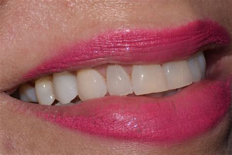 Dental Implants Birmingham Scott Arms