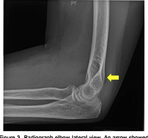 Figure 1 From Point Of Care Ultrasound Sonographic Posterior Fat Pad Sign A Case Report And