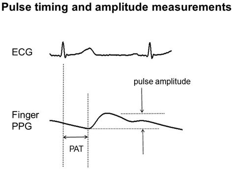 What Is Plethysmogram Wave At Tracy Worsley Blog