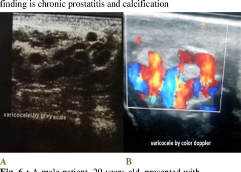 Figure 6 From Role Of Trans Rectal Ultrasonography For Evaluation Of