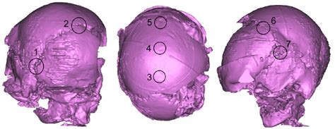 The Ectocranial Vault Suture Closure The Circles Indicate The