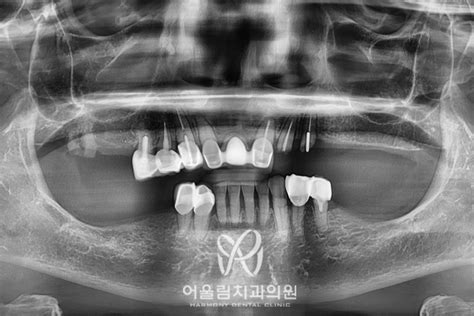 상악 치아손상이 심해 발치 후 틀니치료 어울림치과