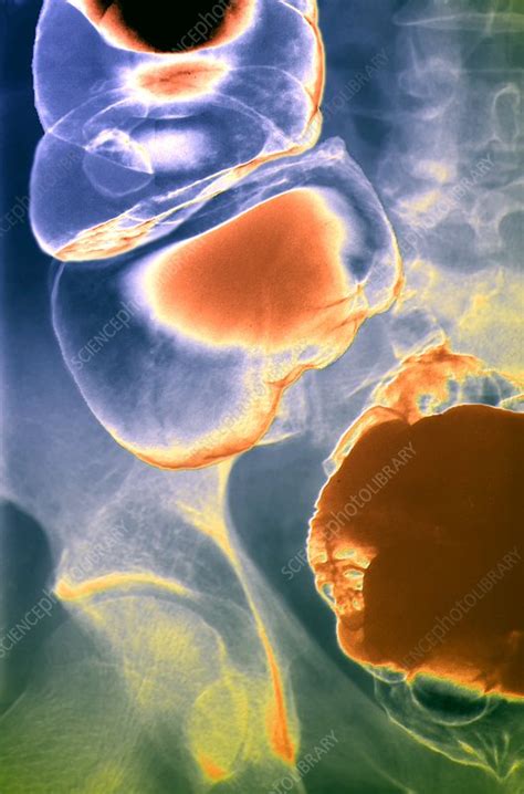 Colonic Polyp X Ray Stock Image C001 7077 Science Photo Library