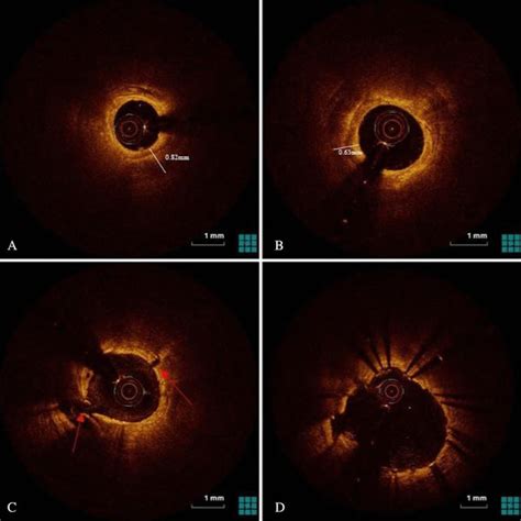Representative Another Case Of Optical Coherence Tomography Oct Download Scientific Diagram