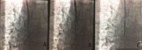 Figure1 A Catheter Thrombosis B Thrombectomy With Fogarty Catheter
