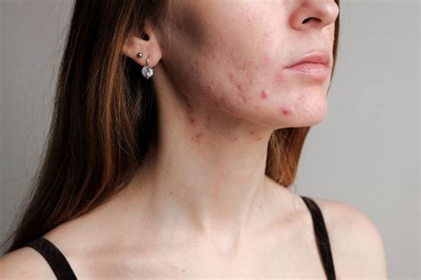Managing Steroid Induced Acne 4 Reasons Why Emu Oil Is The Answer