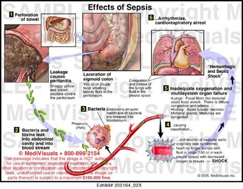 107 Best Sepsis Images On Pinterest Medicine Septic Shock Nursing