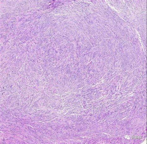 形形色色的胃肠道间质瘤内镜下该如何破 实战篇 MedSci cn