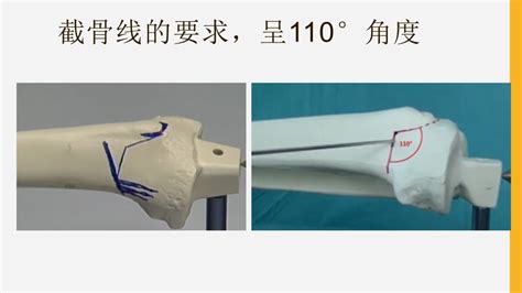 关于胫骨高位截骨术HTO你要掌握的读书笔记 好医术文章 好医术 赋能医生守护生命