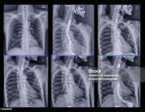 바륨 삼키기 연구 테스트는 Barrett의 위장관 검사 Gerd 궤양 시리즈 어려움 인두 절차 Ugi 형광 투시 장치에 의한 인후 장 요법을 진단합니다 C 암 형광 투시법에