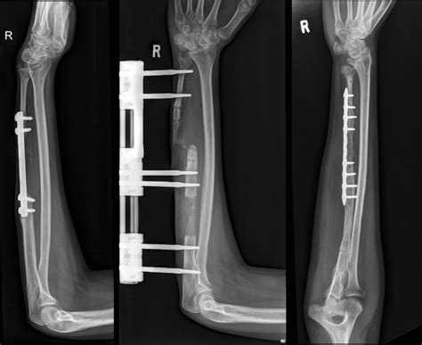 Case Example Of A 40 Mm Ulna Bone Defect Treated By Monolateral Bone Download Scientific