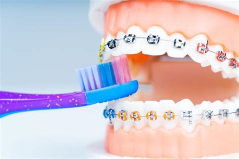 Which Food To Avoid To Stop Staining Of The Braces Blogs Webdental