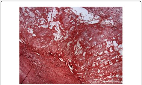 Same Vessel As Figure 2 Congo Red Staining Material Amyloid Within