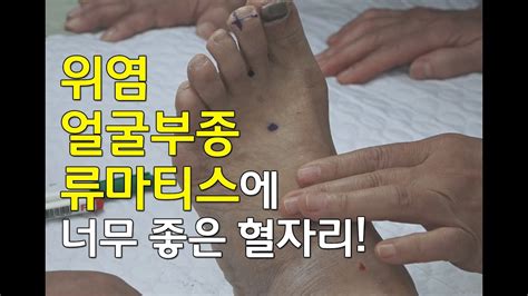 [김효열 교수의 재미있는 혈자리 공부] 위염 얼굴부종 류마티스 관절염 등에 좋은 혈자리 족양명위경 Youtube
