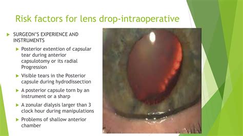 Pars Plana Vitrectomy For Lens Droppptx