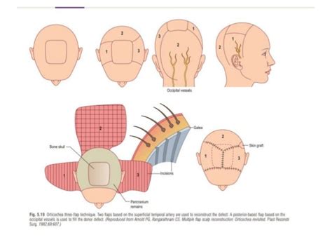 Scalp Reconstruction