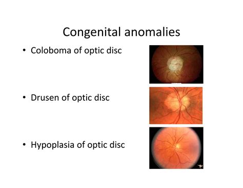 Optic Nervepdf Cranial Nerve Medical Seminar Ppt