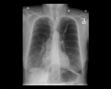 Lungs The Lungs Are Hyperinflated
