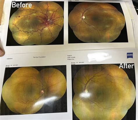 Dr Shan Aboo Hussain On Linkedin Branch Retinal Vein Occlusion Brvo