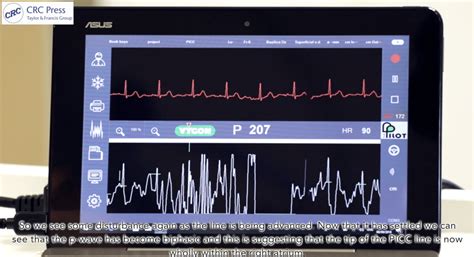 Pilot Software That Uses Ecg Guidance Technology To Accurately Place