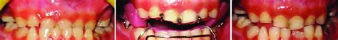 A Preoperative Intraoral Frontal View B Reverse Twin Block