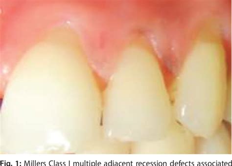 Figure 1 From Treatment Of Multiple Gingival Recessions Using Modified Tunnel Technique With V