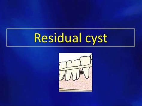 Odontogenic Cysts