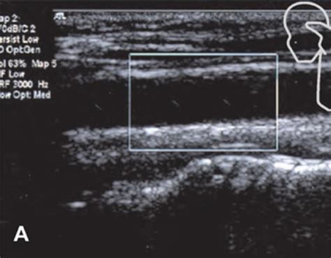 Ch 20 Optimizing Doppler Imaging Flashcards Quizlet
