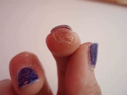 Alergia A Los Productos De Uñas Gel Acrílico Esmaltes Permanentes