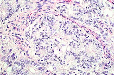 Endometrioid Carcinoma Of The Ovary Mypathologyreportca